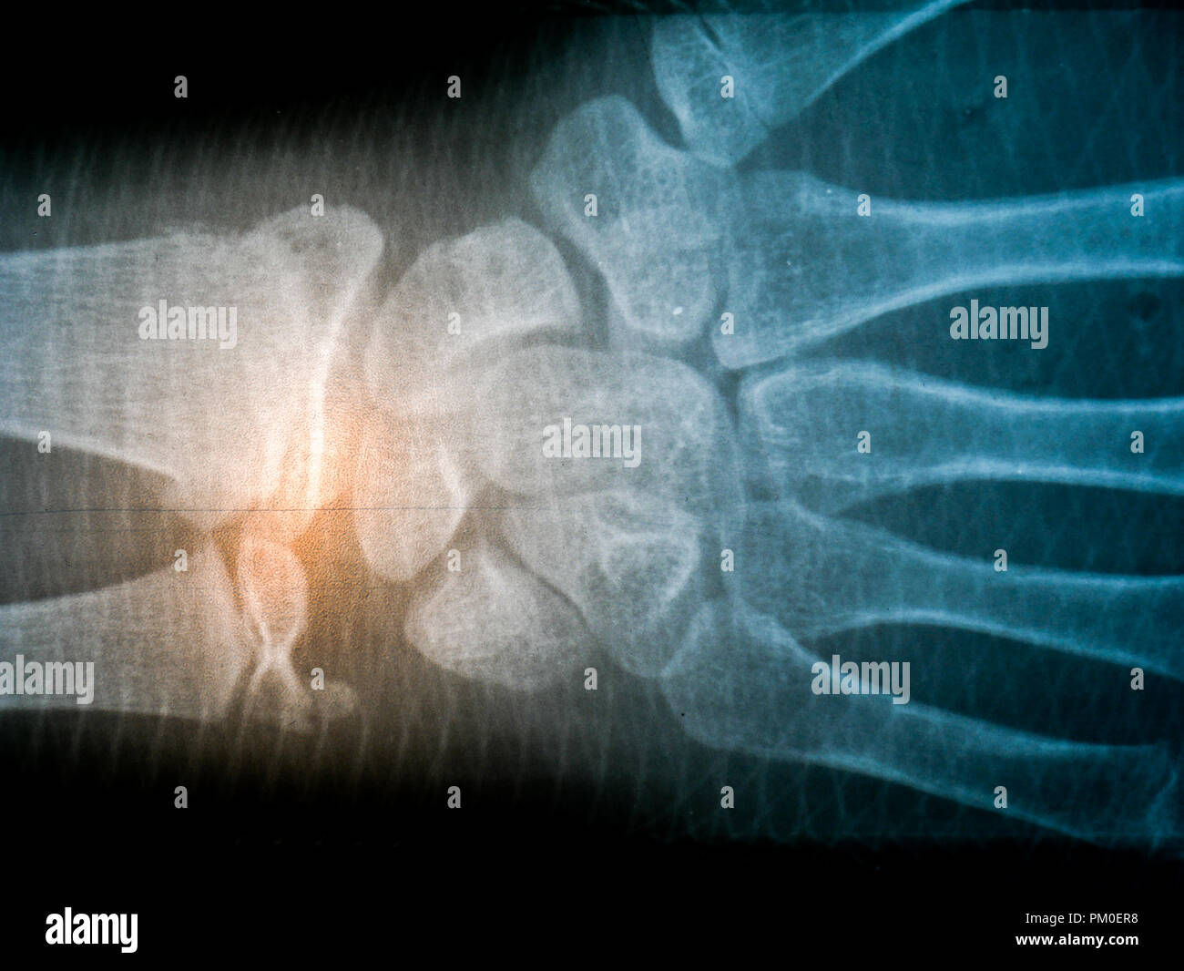 x-ray film skeleton human arm. health medical anatomy body concept ...