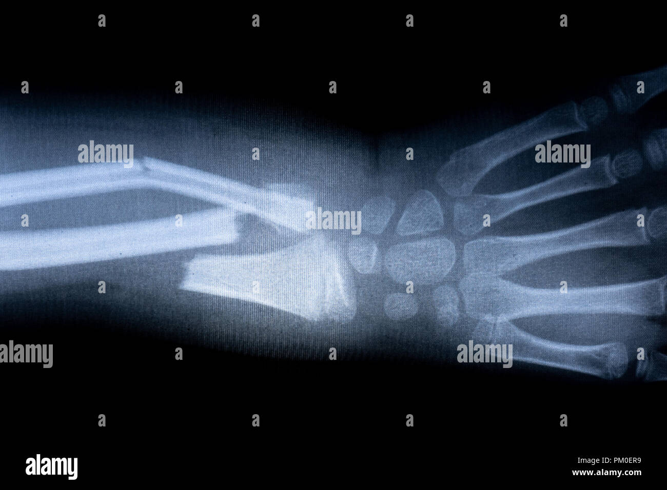 Broken arm x ray isolated hi-res stock photography and images - Alamy