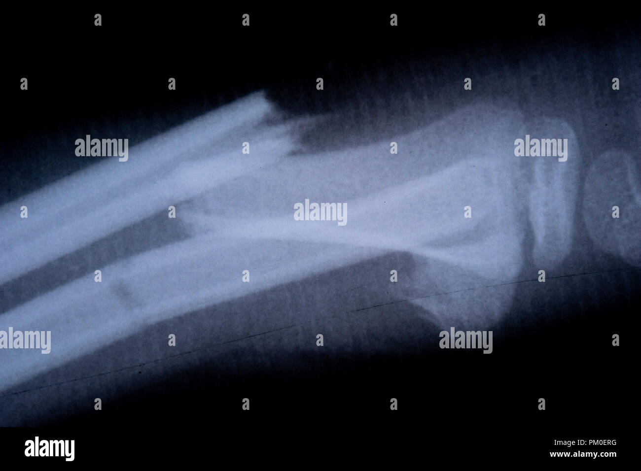 x-ray film skeleton human arm. health medical anatomy body concept ...
