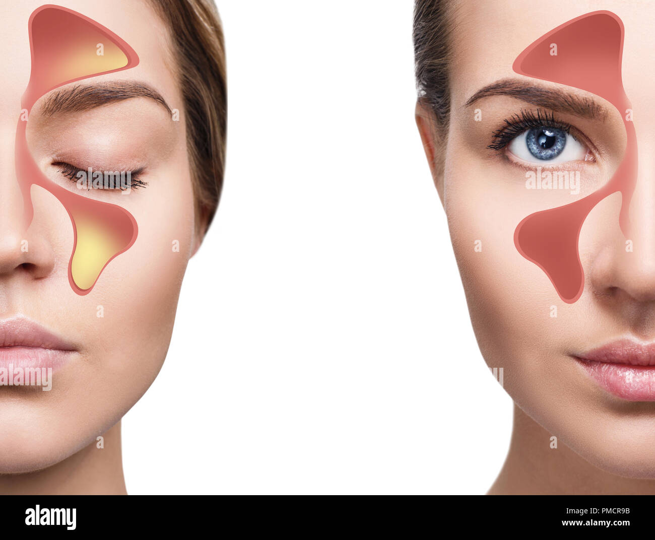 Female face shows nasal sinus with cold over white background Stock ...