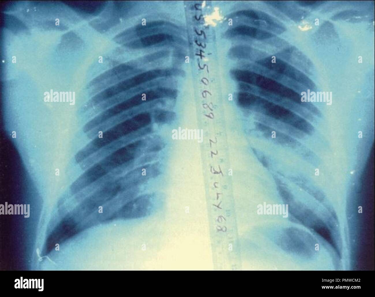 Chest radiograph hi-res stock photography and images - Alamy