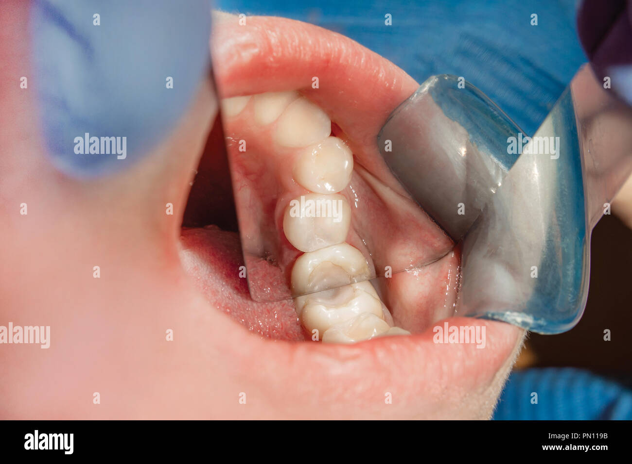 Restorative dentistry hi-res stock photography and images - Alamy