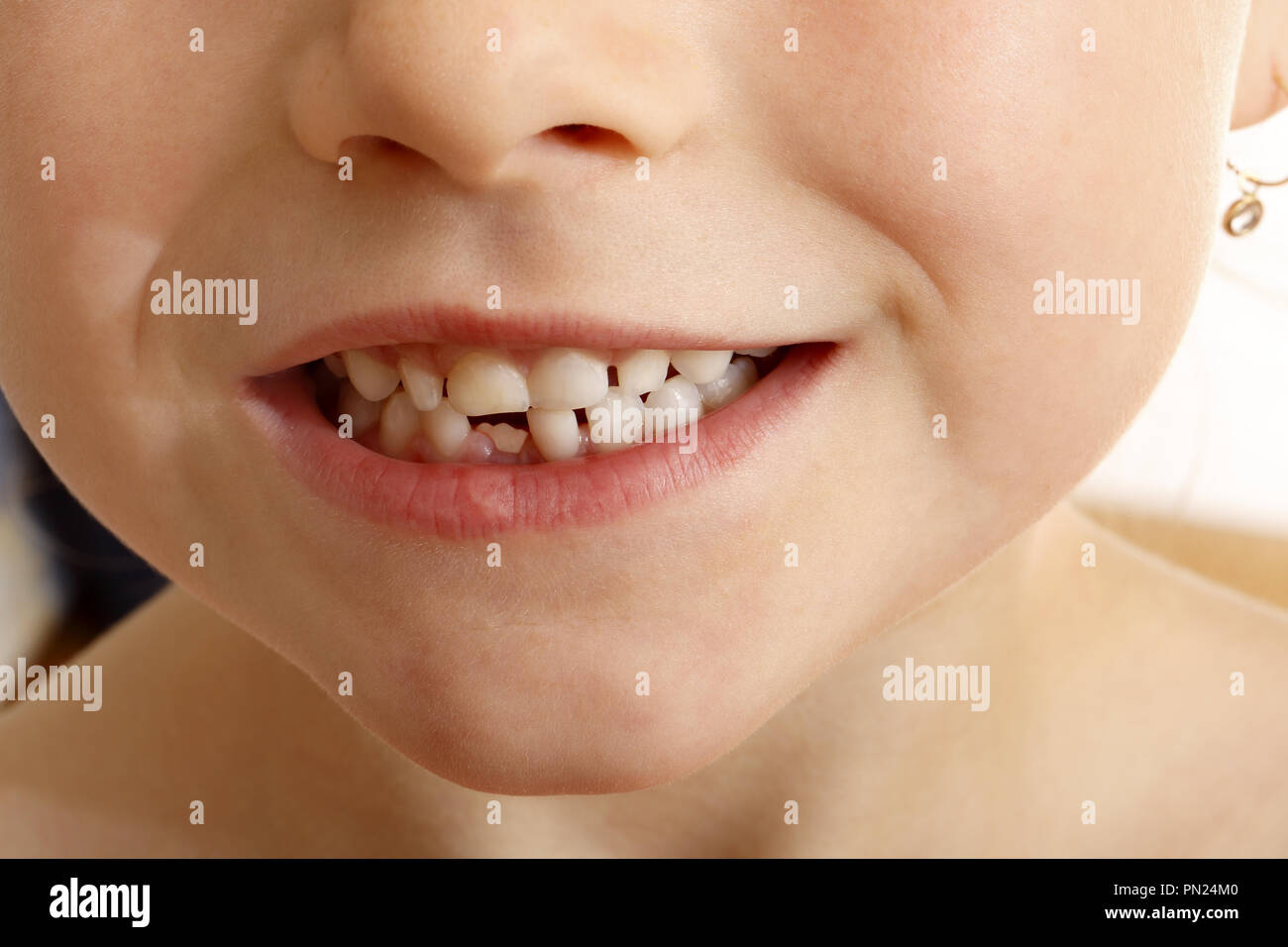 Missing baby teeth hi-res stock photography and images - Alamy