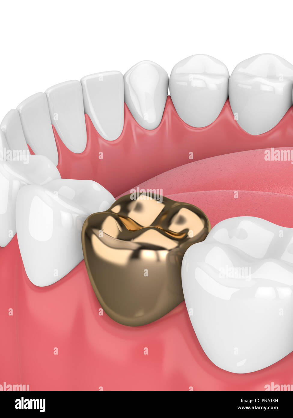 3d render of teeth in gums with golden dental crown restoration over ...
