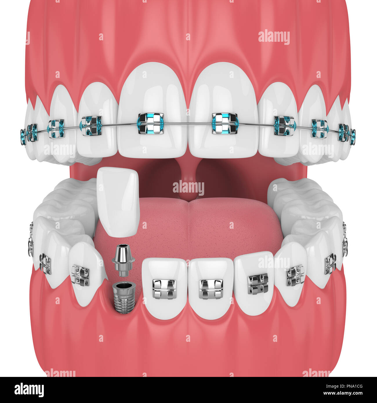 3d render of teeth with orthodontic braces and dental implant ...