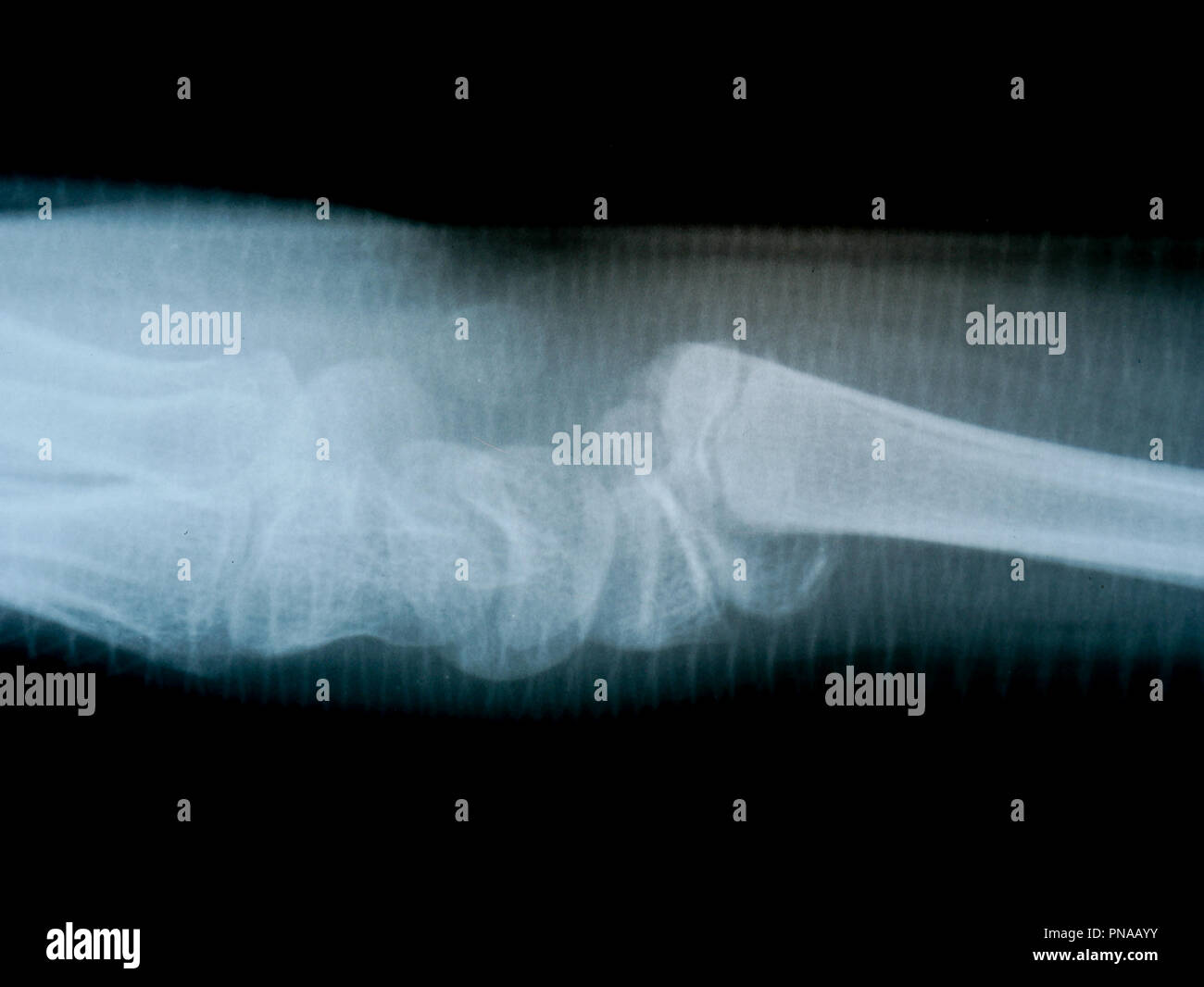 x-ray film skeleton human arm. health medical anatomy body concept ...