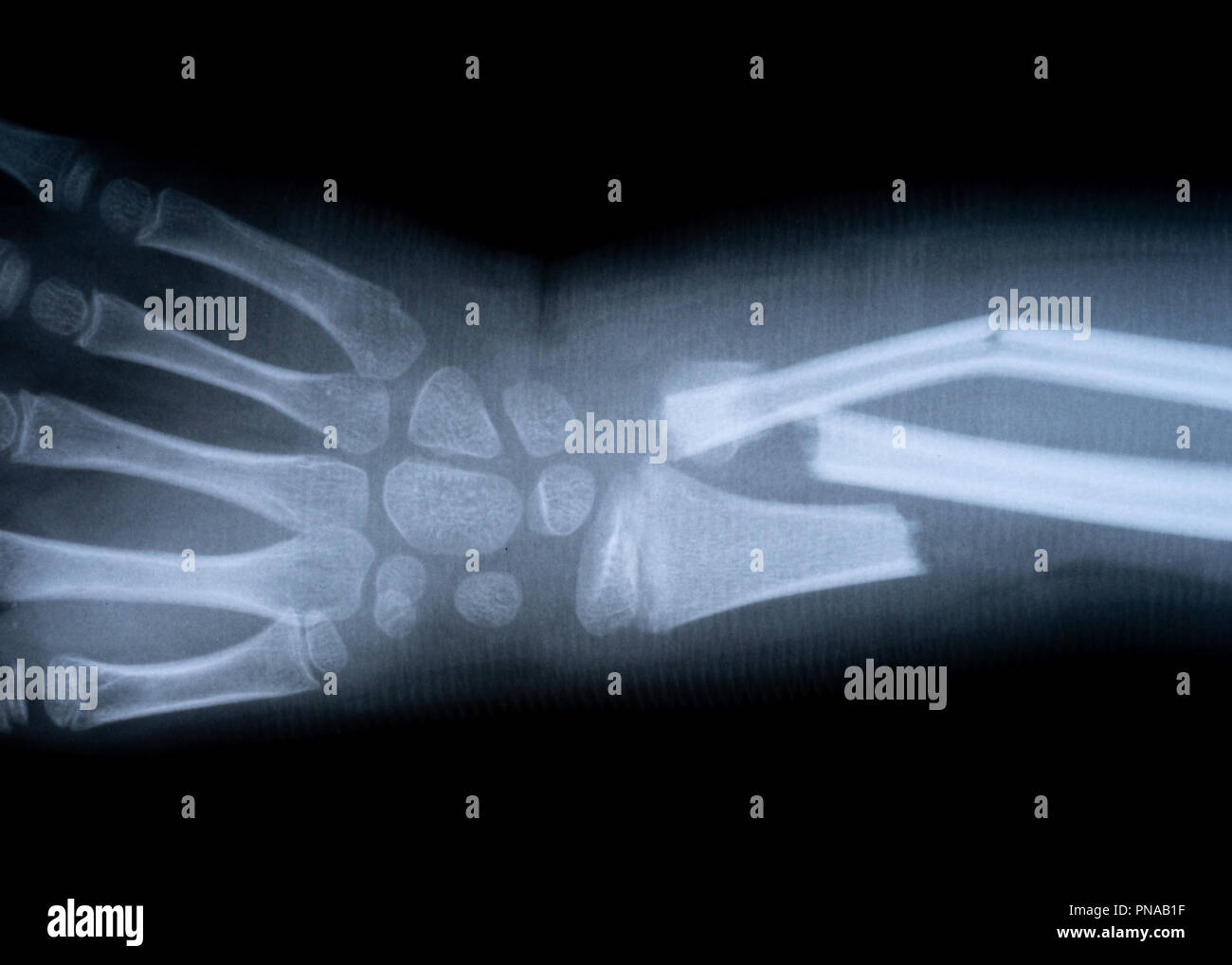 x-ray film skeleton human arm. health medical anatomy body concept ...