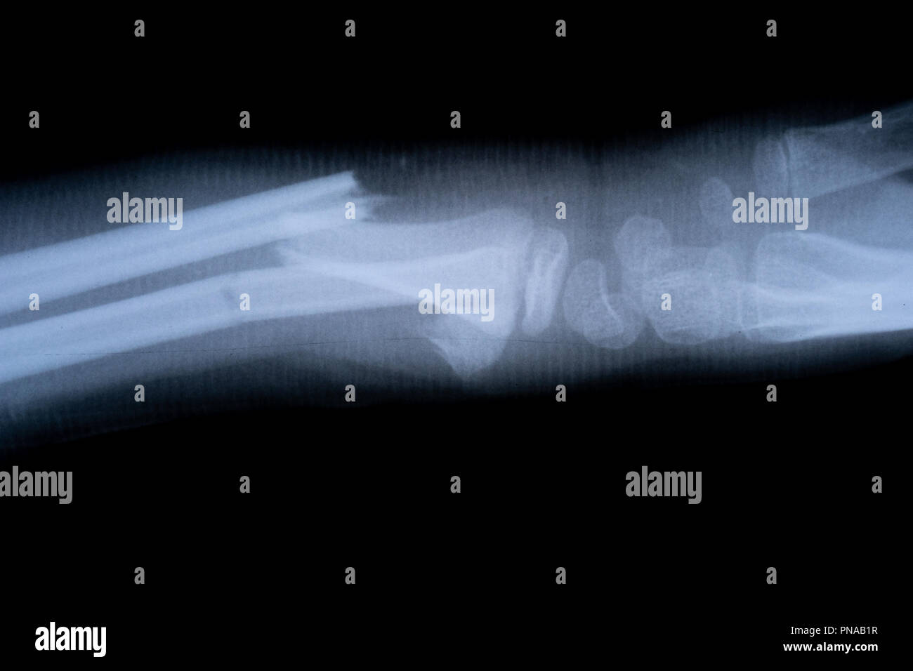 x-ray film skeleton human arm. health medical anatomy body concept ...
