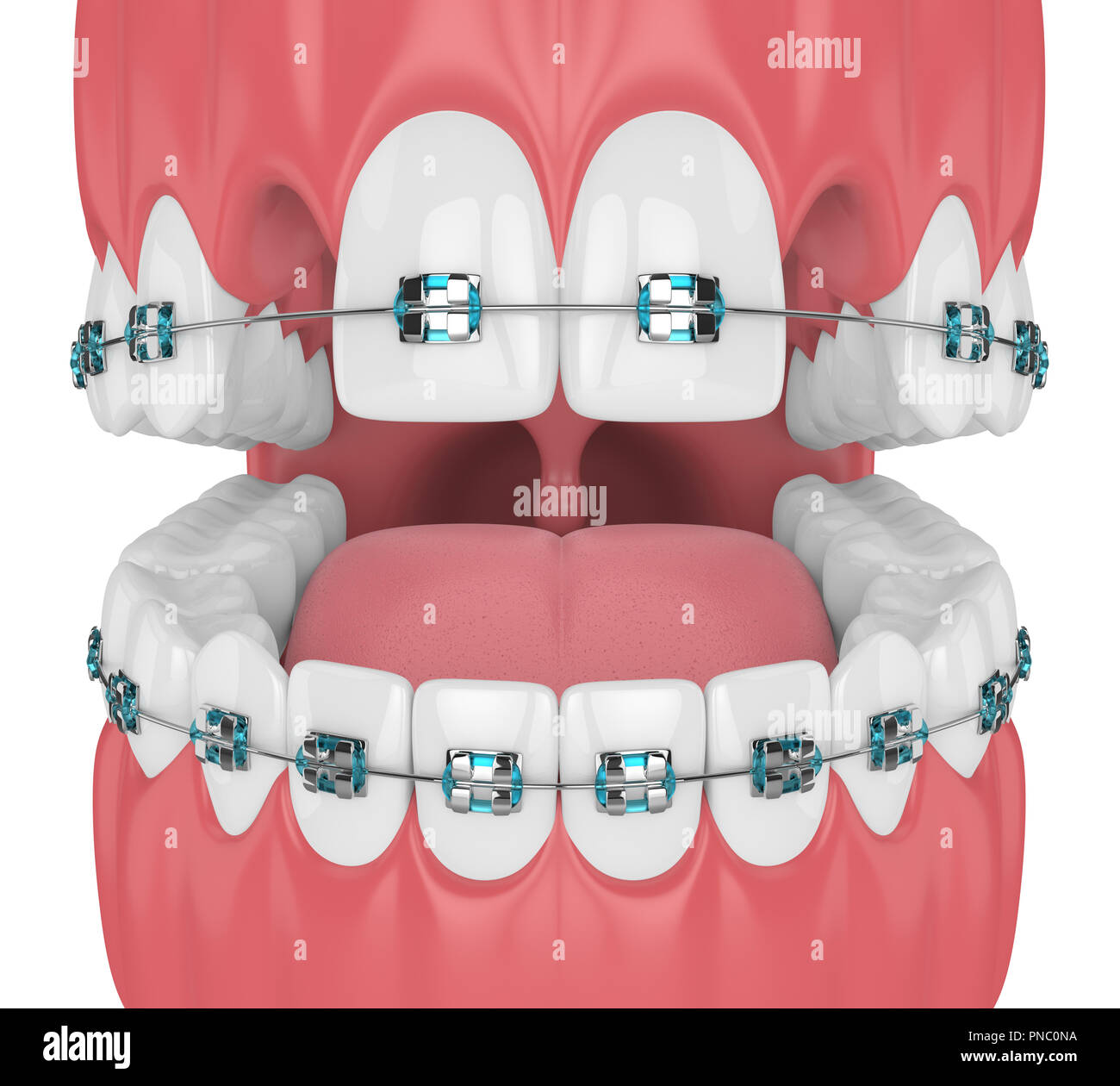 3d render of teeth with orthodontic braces and cavities. Orthodontic ...
