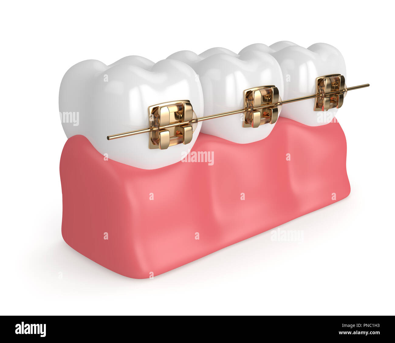 3d render of teeth with golden orthodontic braces isolated over white ...