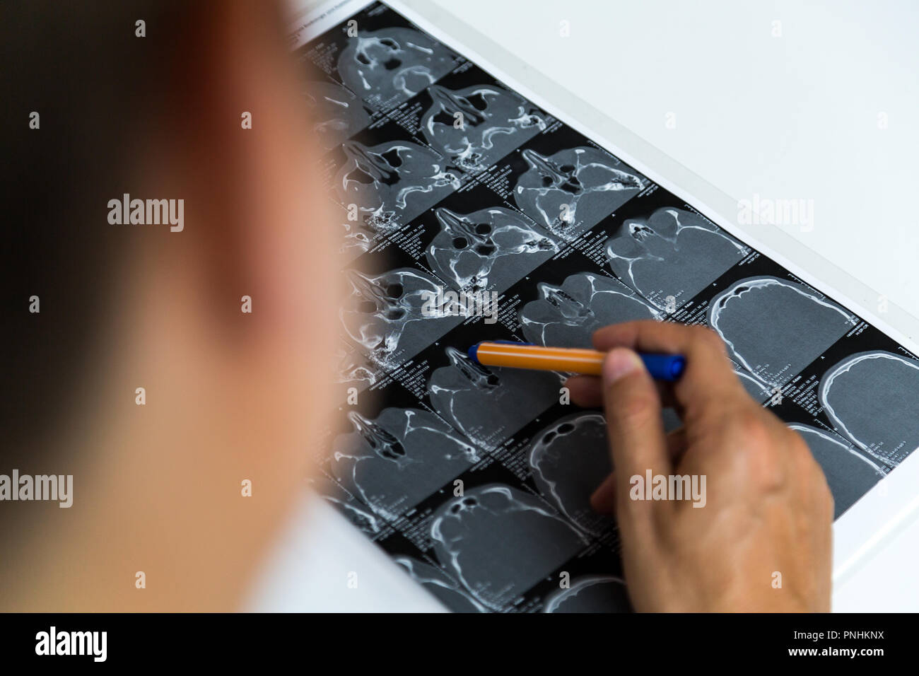 CT scans on desk and doctor hands pointing at x-ray with pen. Over the ...
