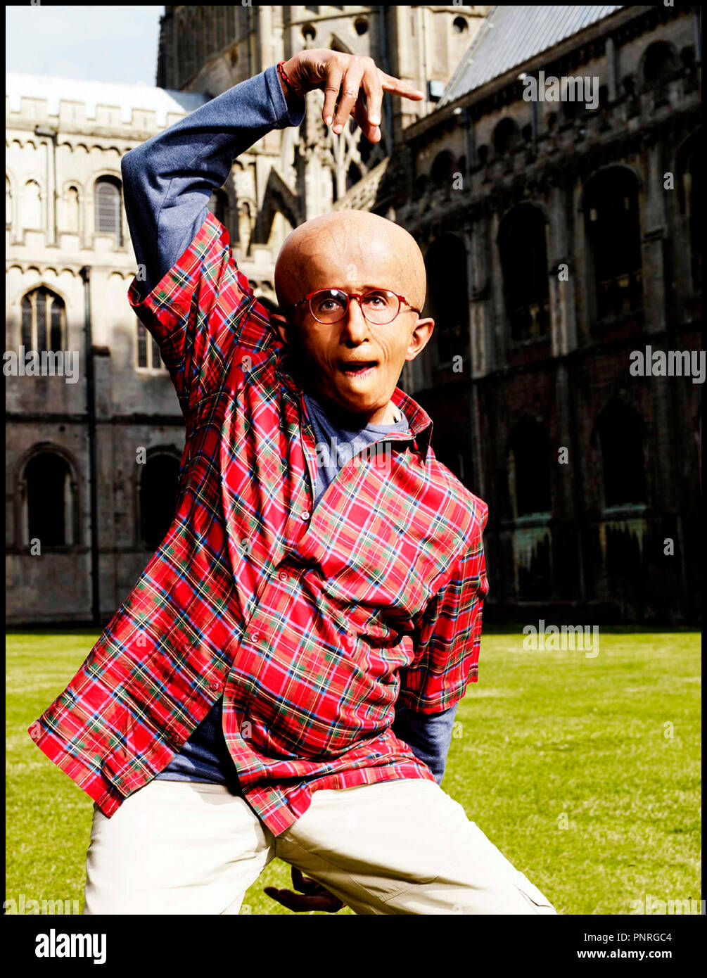 Progeria Stock Photos & Progeria Stock Images - Alamy