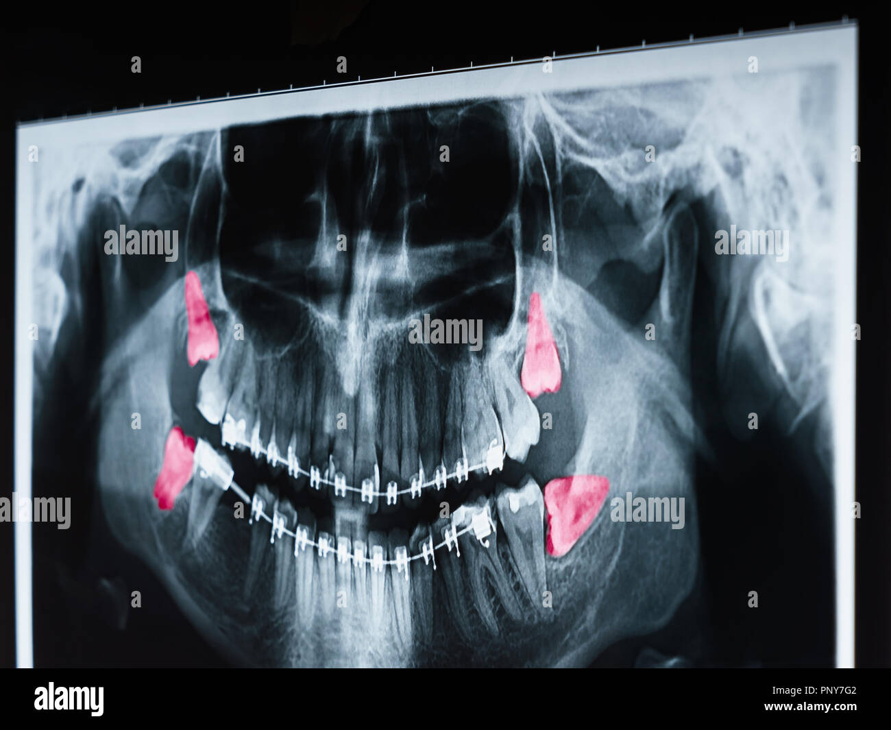 Growing Wisdom Teeth Pain On X-Ray Stock Photo - Alamy