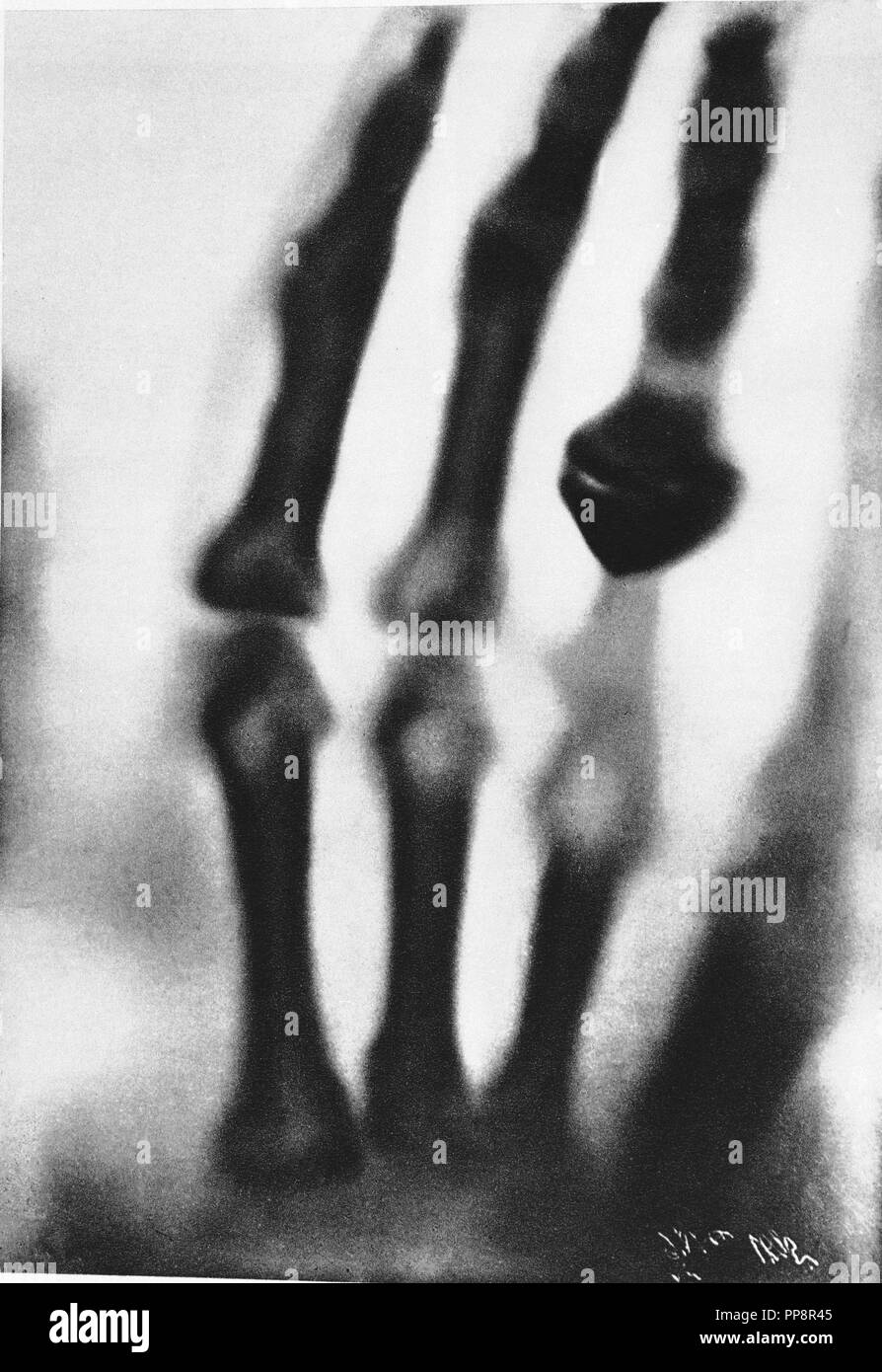 Roentgen hand hi-res stock photography and images - Alamy