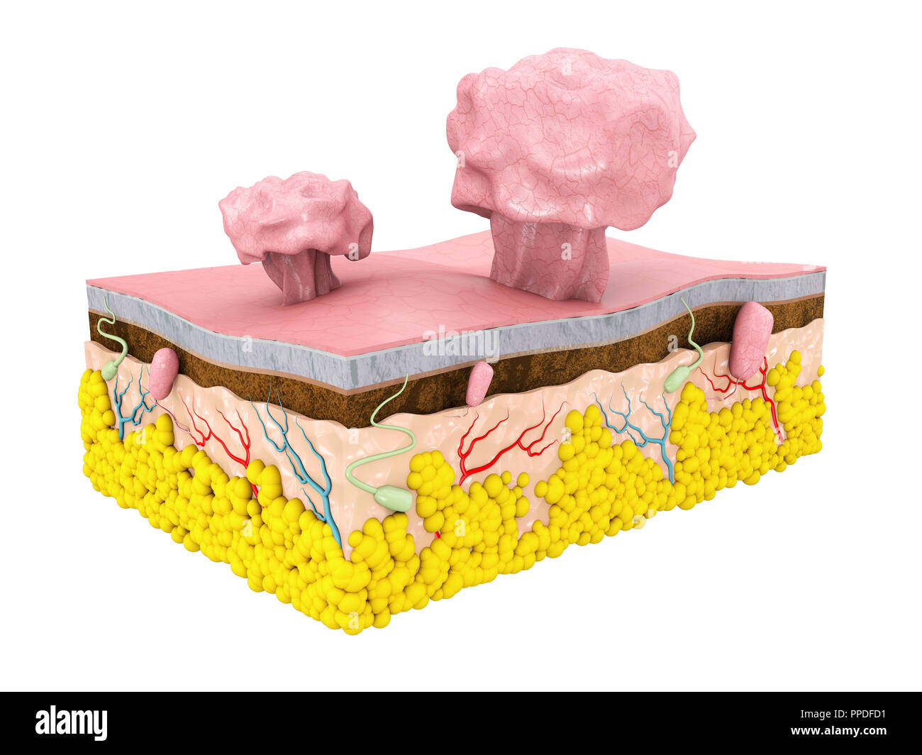 3d Illustration of Polype with Skin structure, isolated white ...