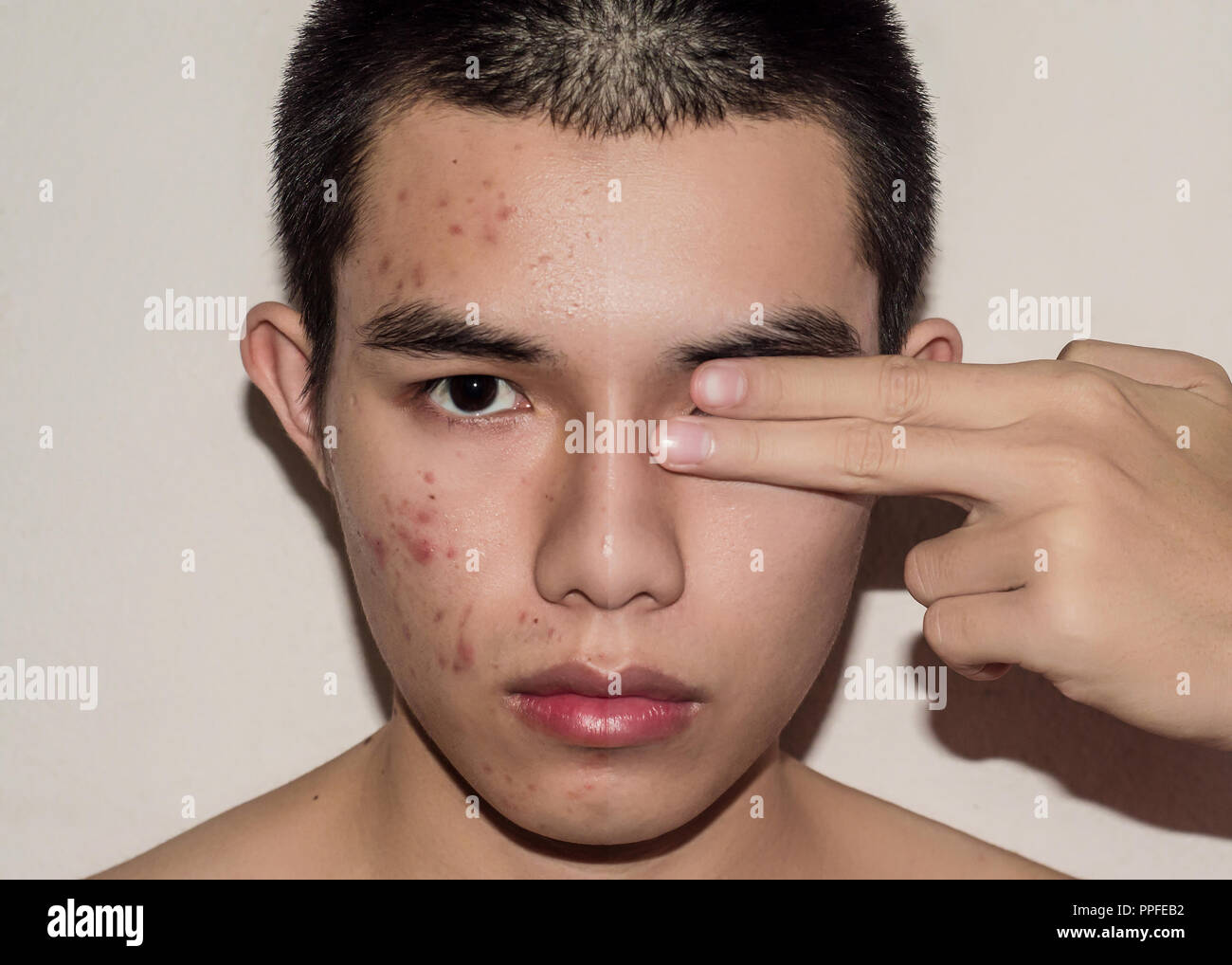 Young man with before and after treatment from acne and pimple, Before ...