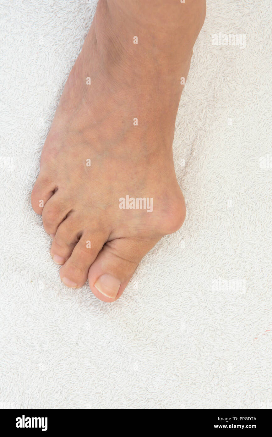 Big toe hi-res stock photography and images - Alamy
