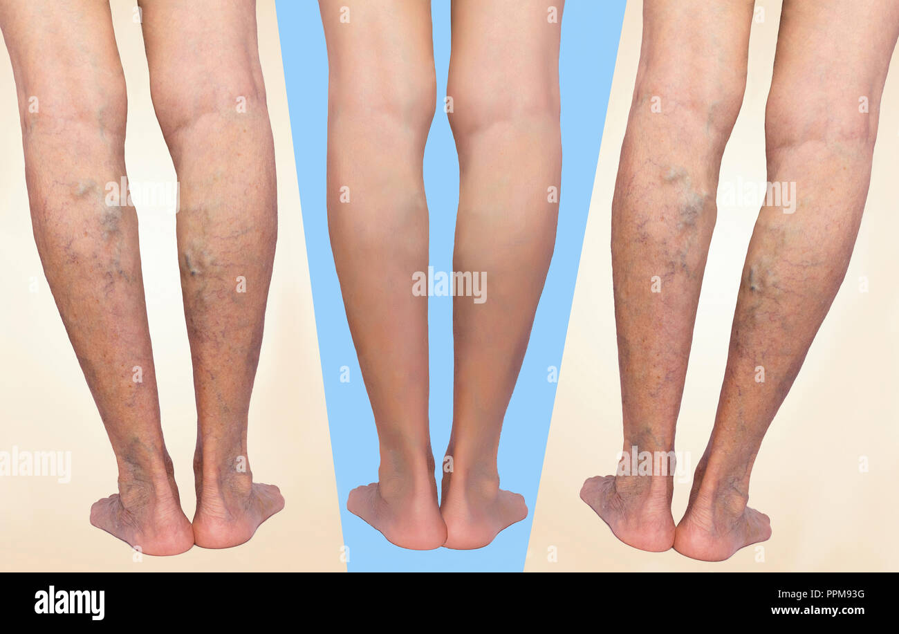Treatment of varicose before and after. Varicose veins on the legs ...
