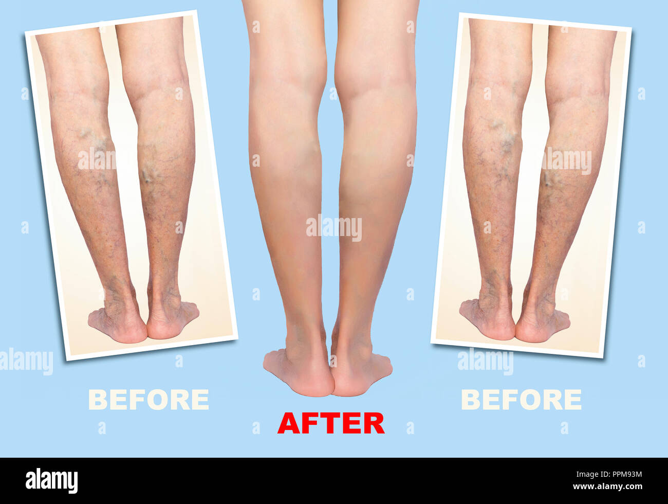 Treatment of varicose before and after. Varicose veins on the legs ...
