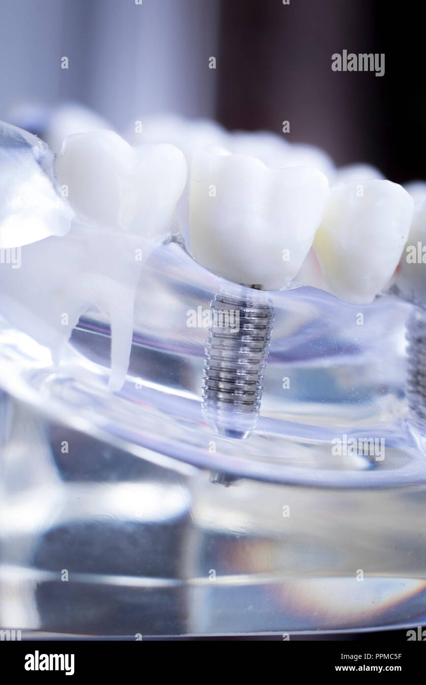 Dentist dental teeth teaching model showing titanium metal tooth ...