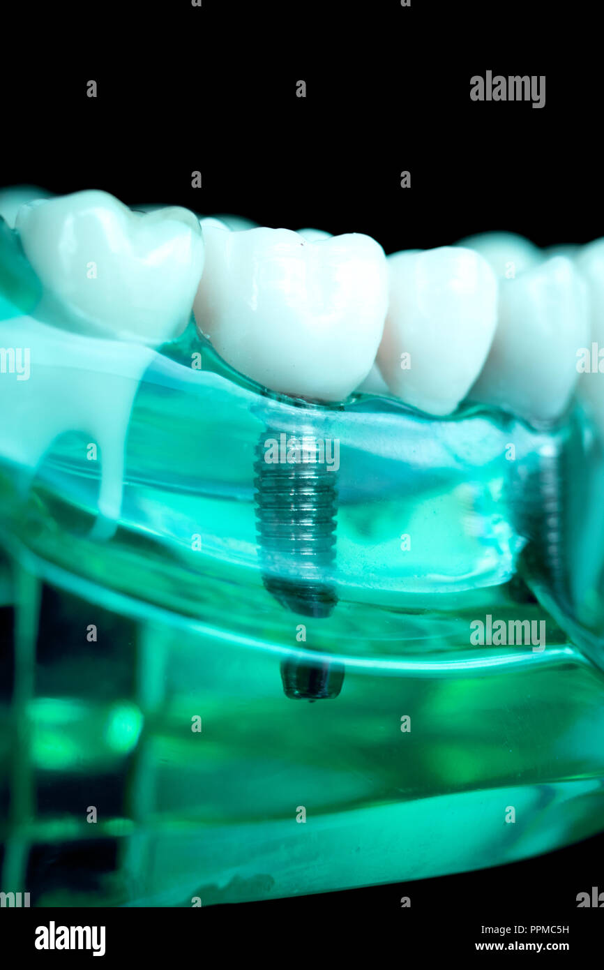 Dentist dental teeth teaching model showing titanium metal tooth ...
