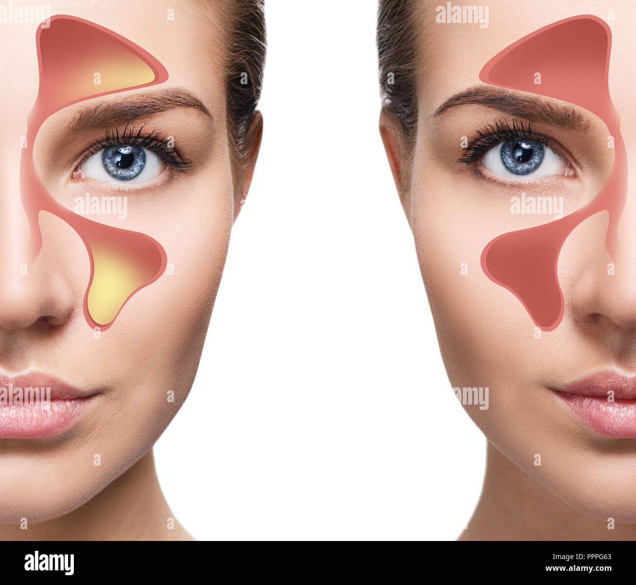 Female face shows nasal sinus with cold over white background Stock ...