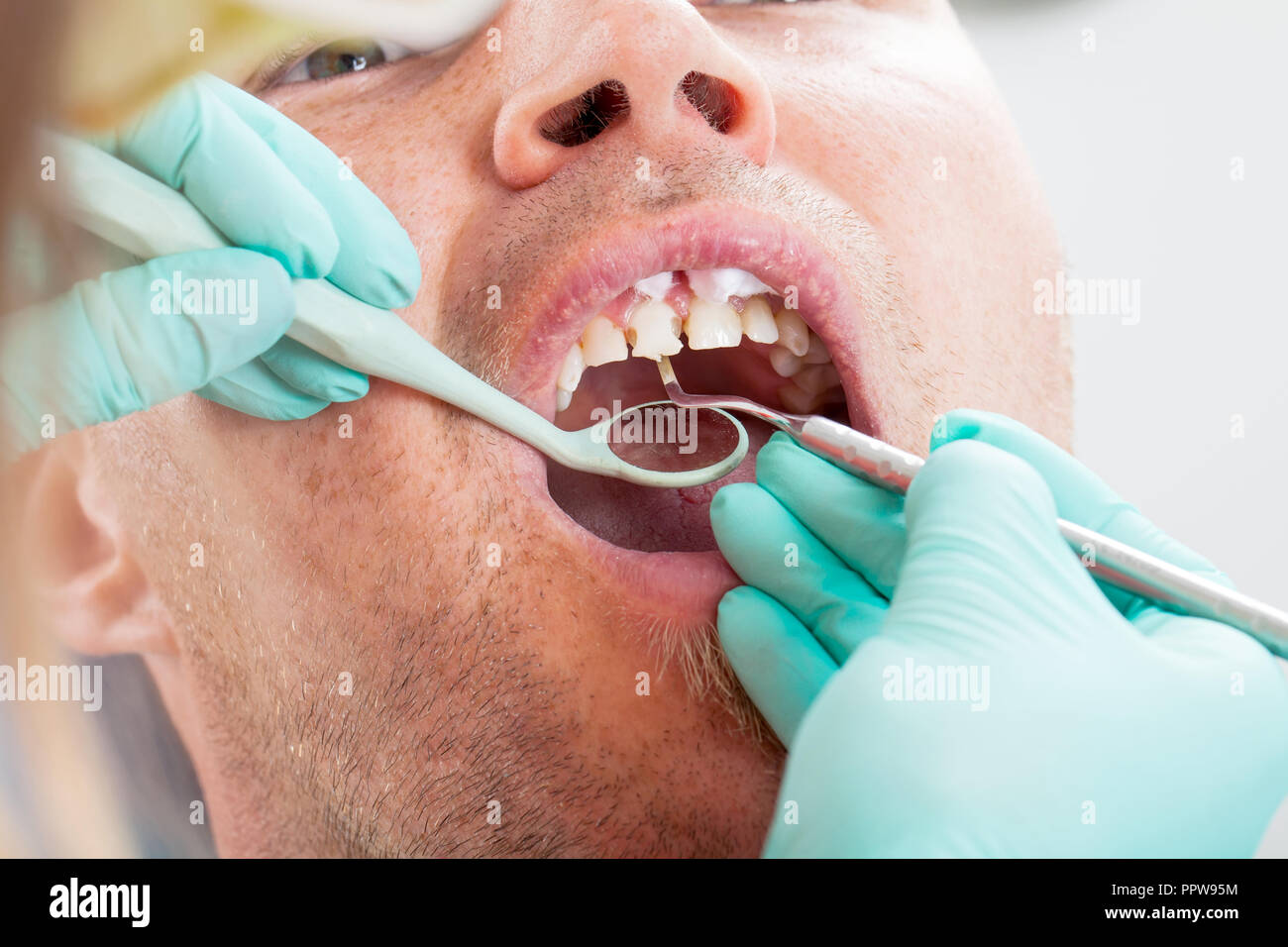 Man getting a front dental filling Stock Photo - Alamy