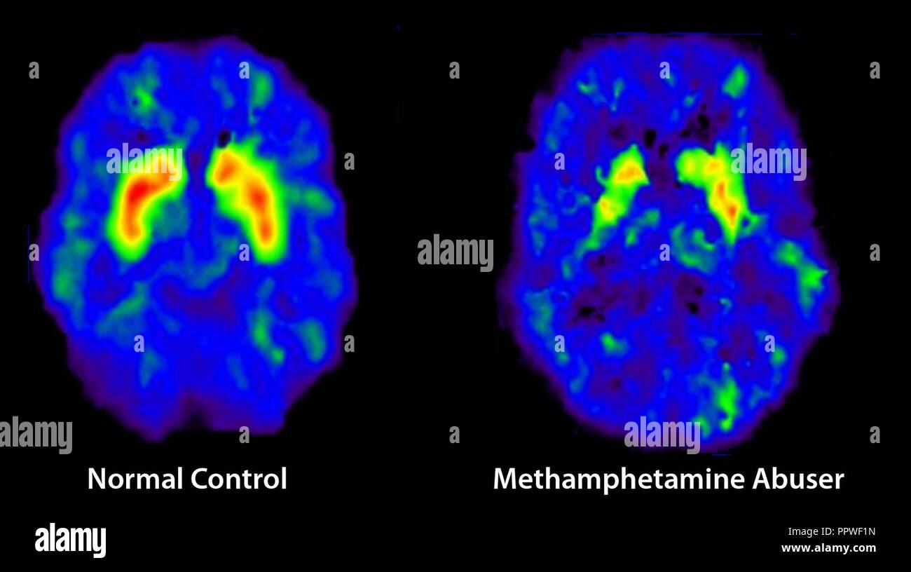 Brain Scan - Methamphetamine Stock Photo - Alamy