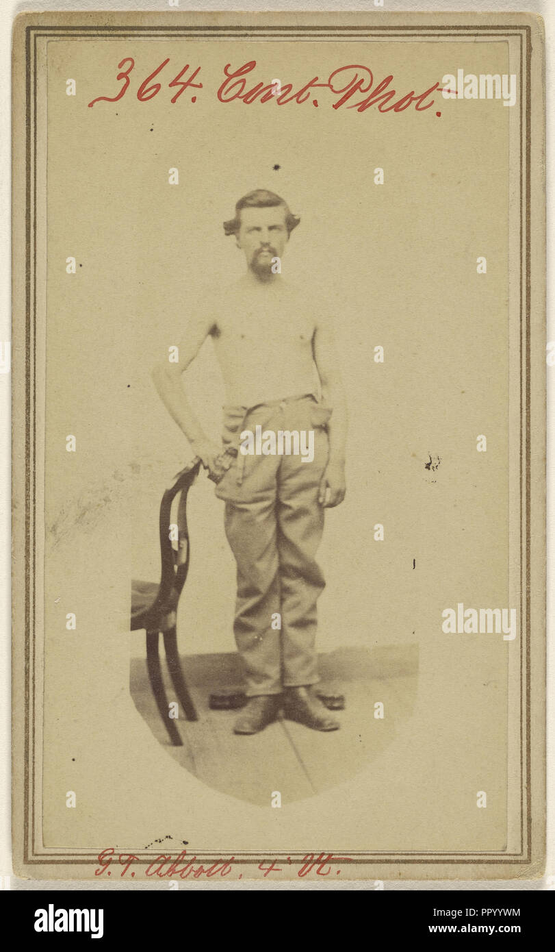 George T. Abbot, False joint of the humerus after a G.S. Fracture ...