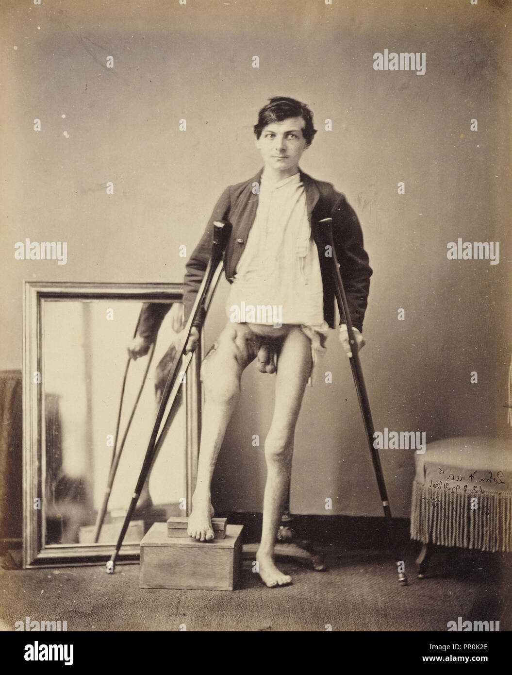 Gunshot Fracture of the Shaft of the Right Femur, United with Great ...