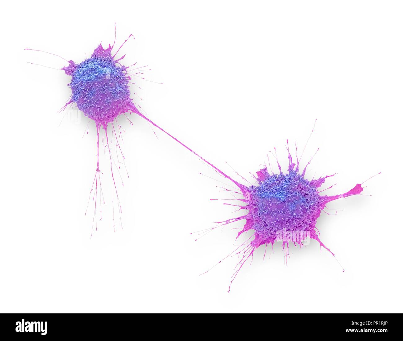 Dividing prostate cancer cells, coloured scanning electron micrograph ...