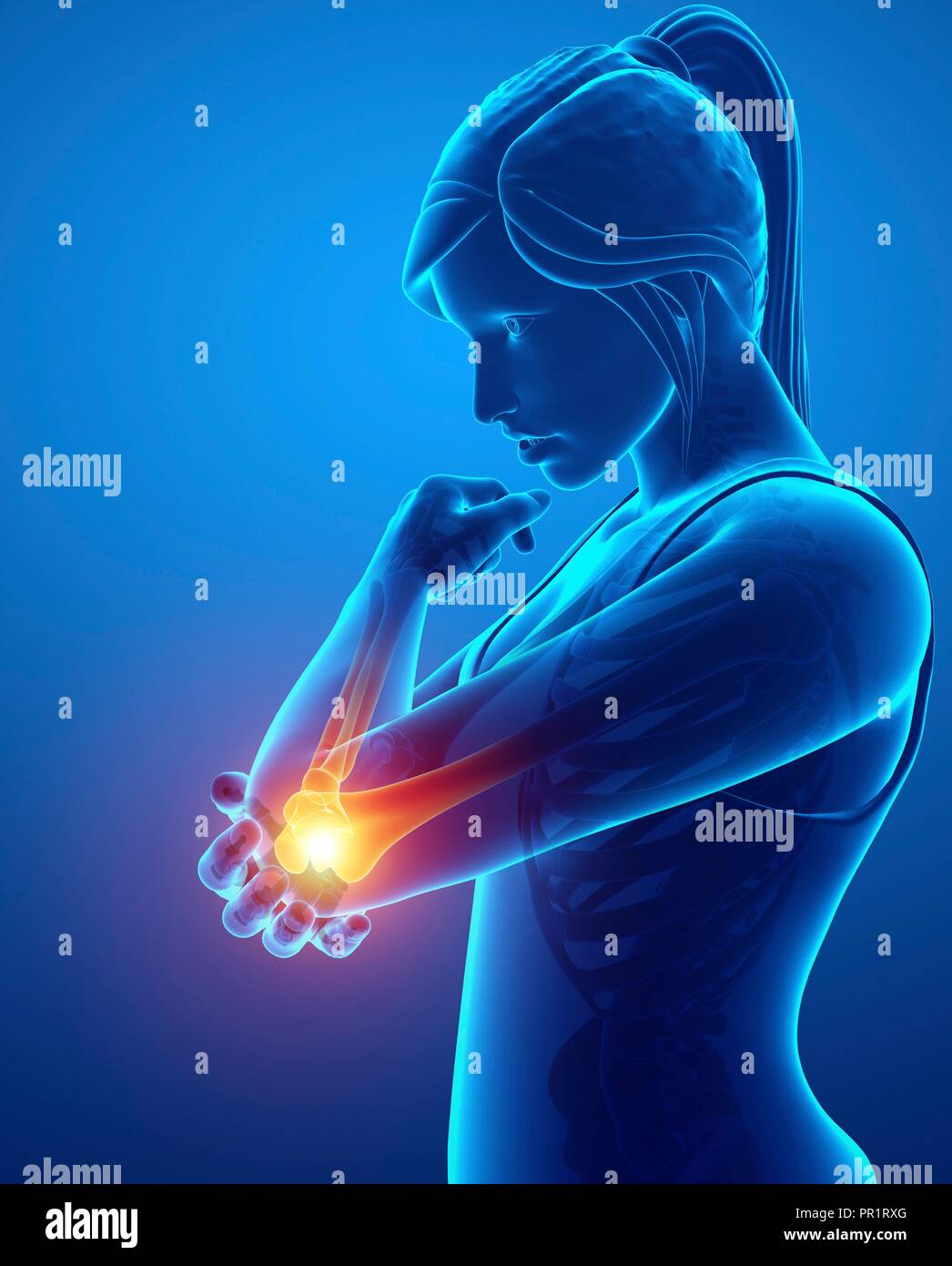 Woman with elbow pain, computer illustration Stock Photo - Alamy