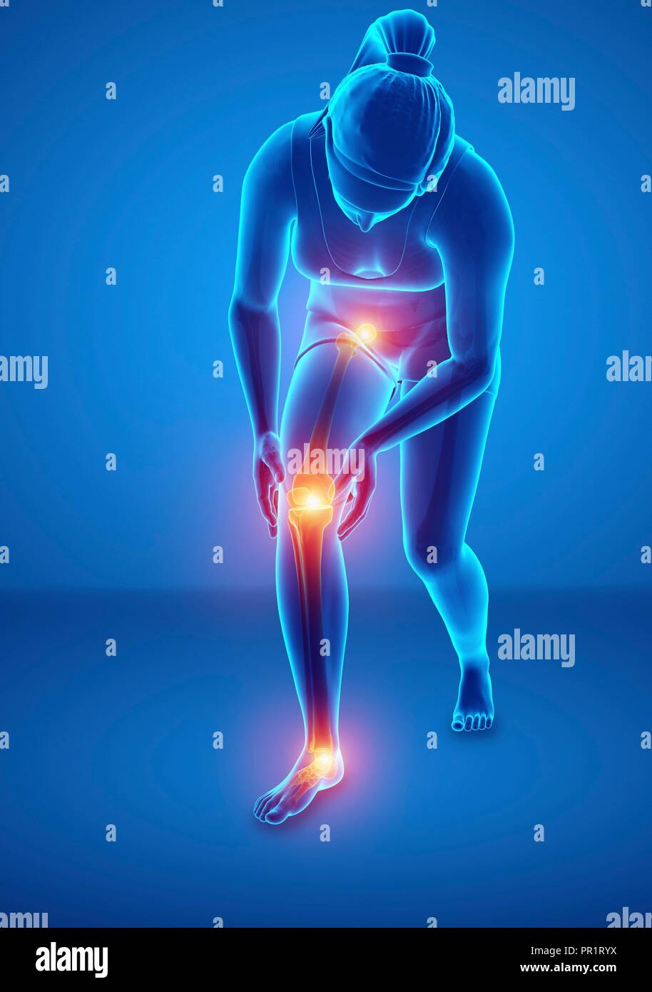 Woman with leg pain, computer illustration Stock Photo - Alamy