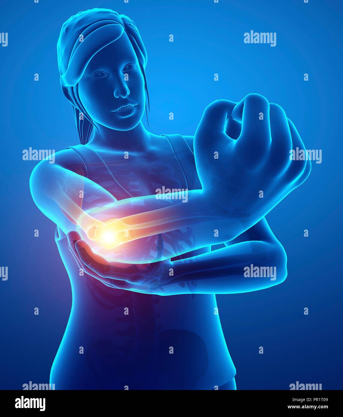 Woman with elbow pain, computer illustration Stock Photo - Alamy