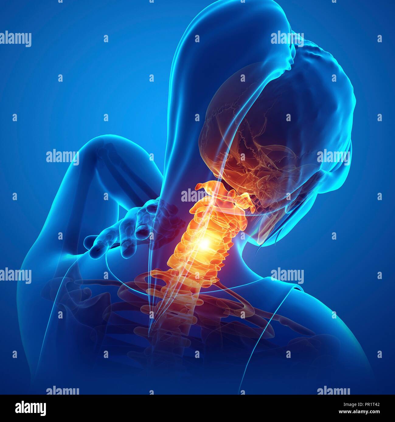 Woman with neck pain, computer illustration Stock Photo - Alamy