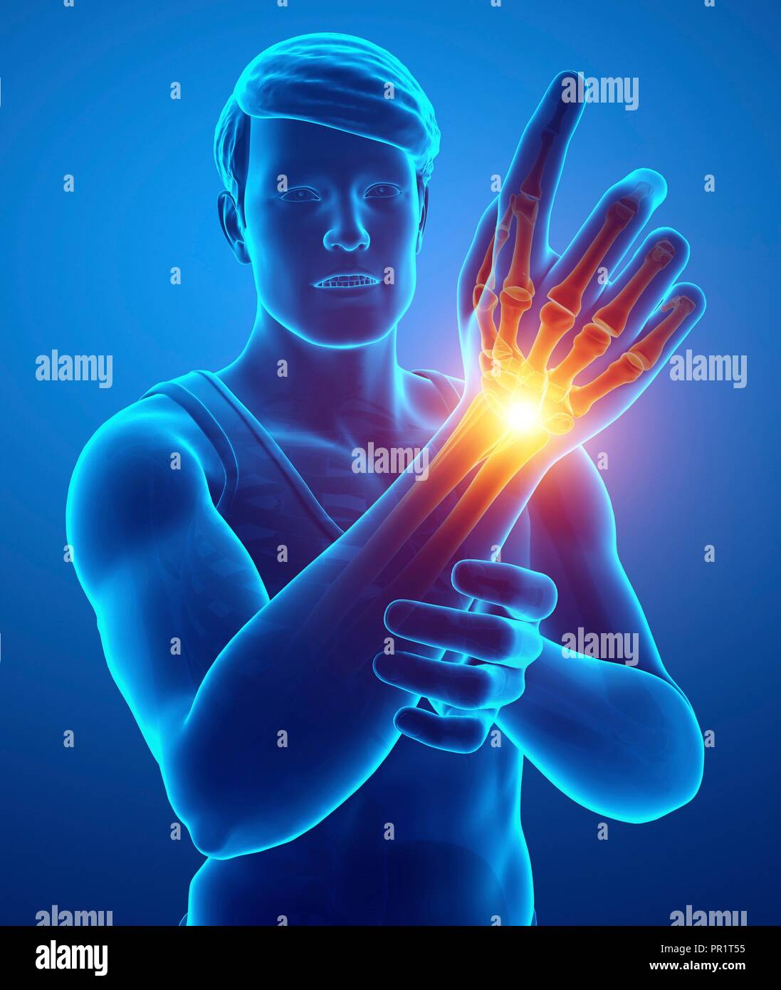 Man with wrist pain, computer illustration Stock Photo - Alamy