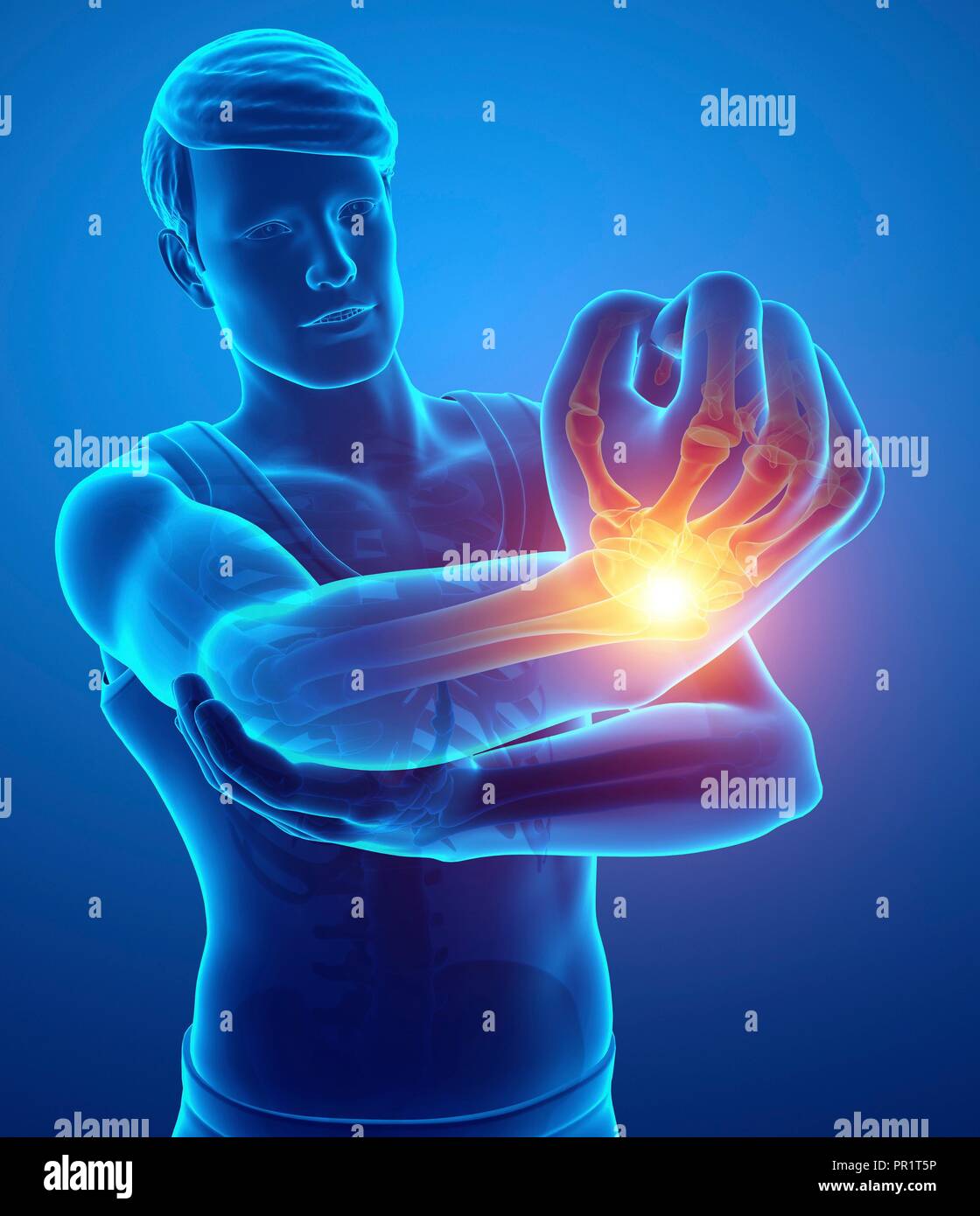 Man with wrist pain, computer illustration Stock Photo - Alamy