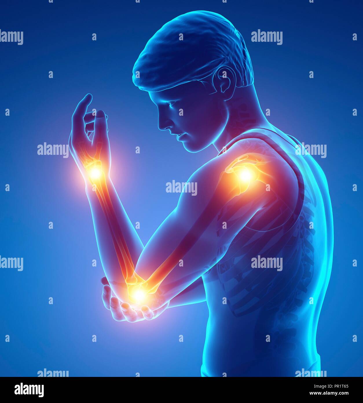 Man with arm pain, computer illustration Stock Photo - Alamy
