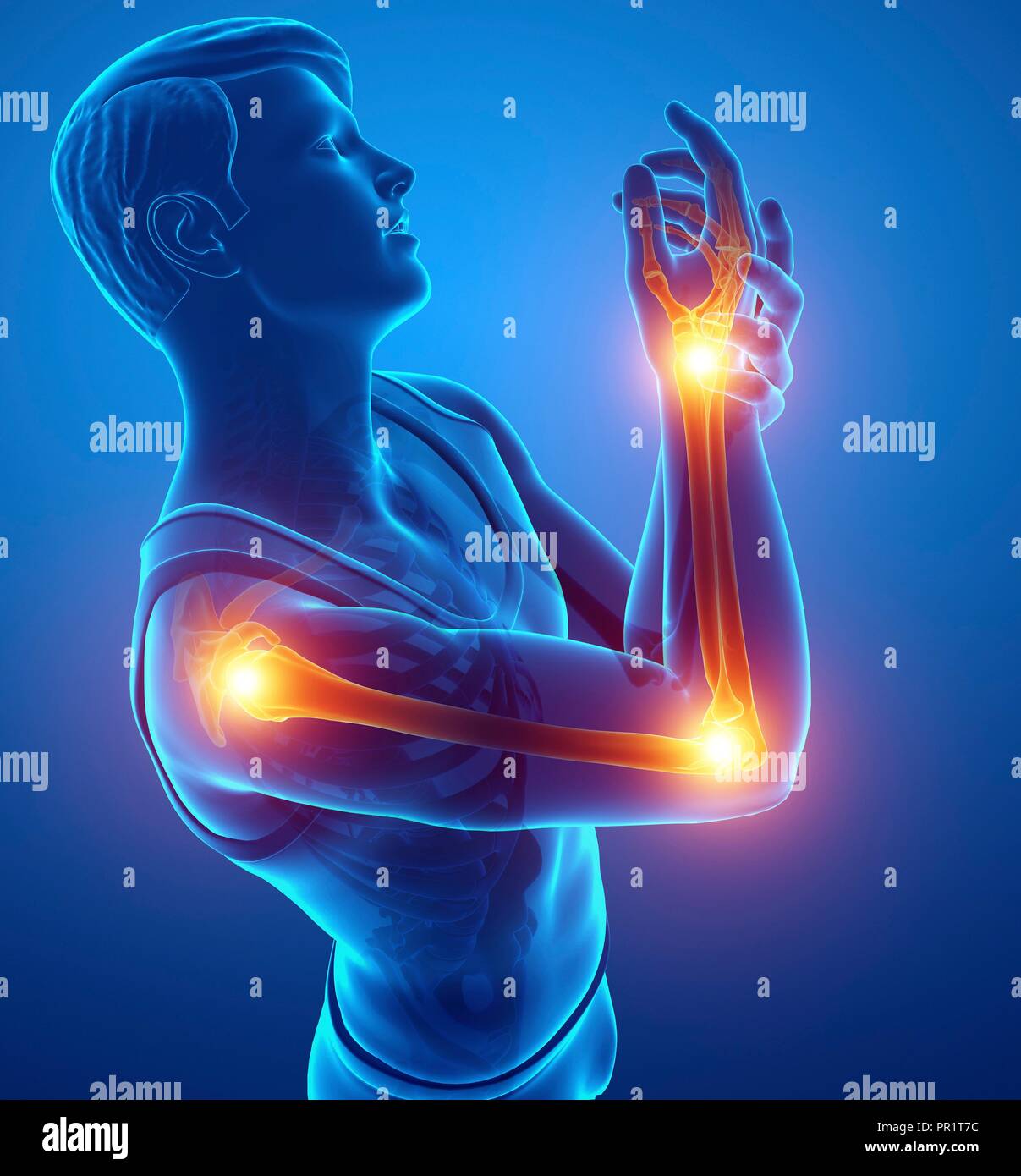 Man with arm pain, computer illustration Stock Photo - Alamy
