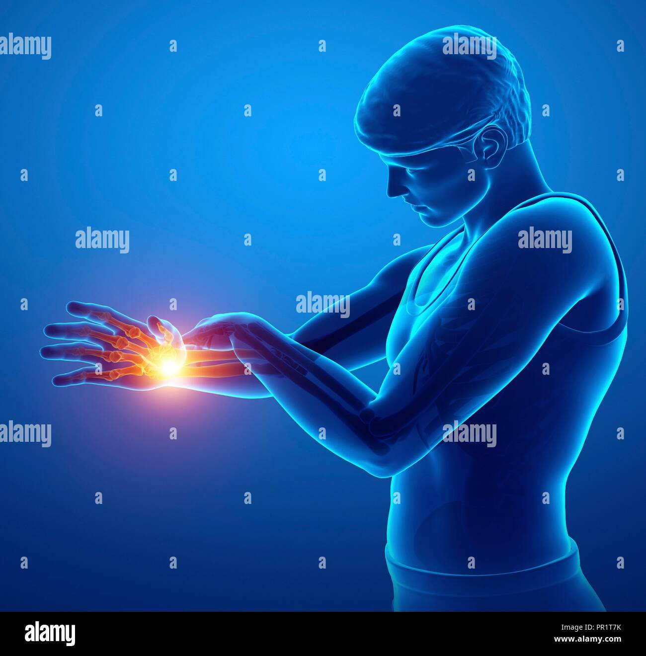 Man with wrist pain, computer illustration Stock Photo - Alamy