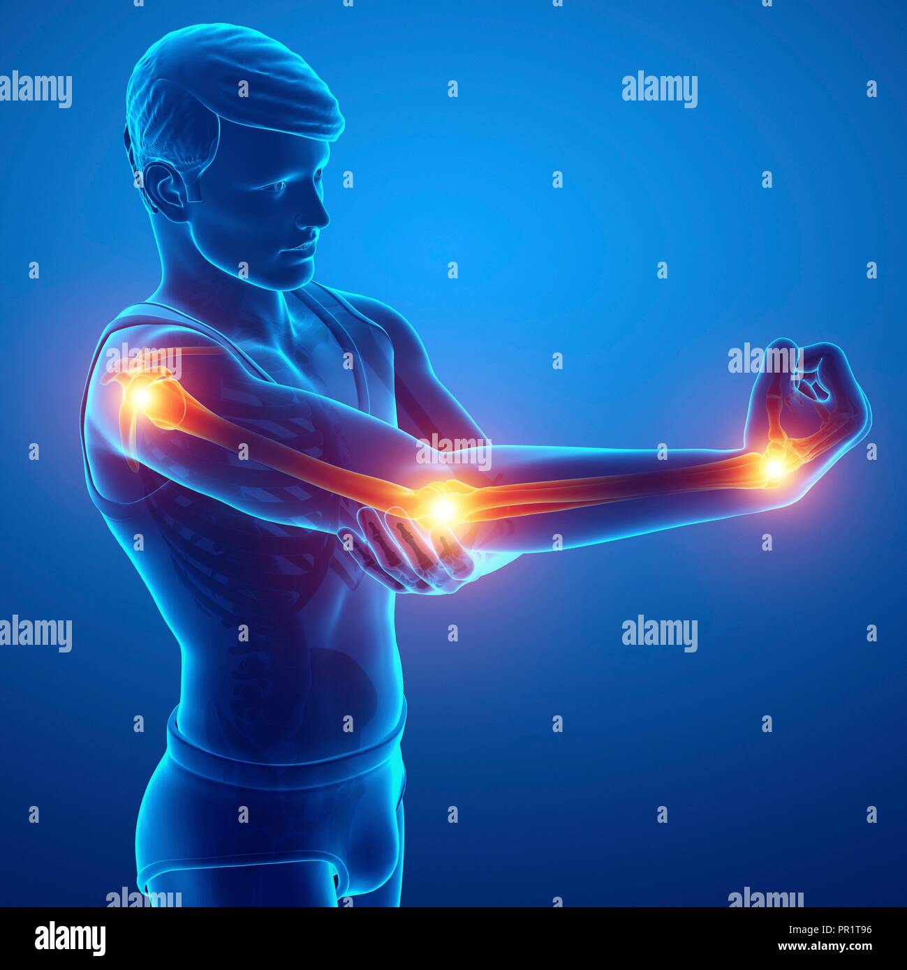 Man with arm pain, computer illustration Stock Photo - Alamy