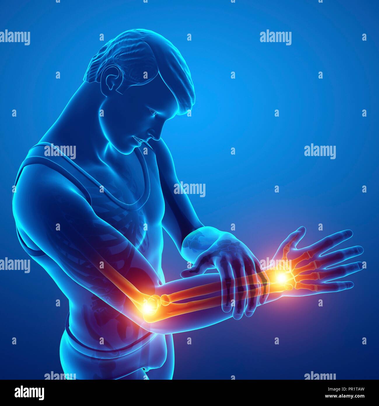 Man with arm pain, computer illustration Stock Photo - Alamy