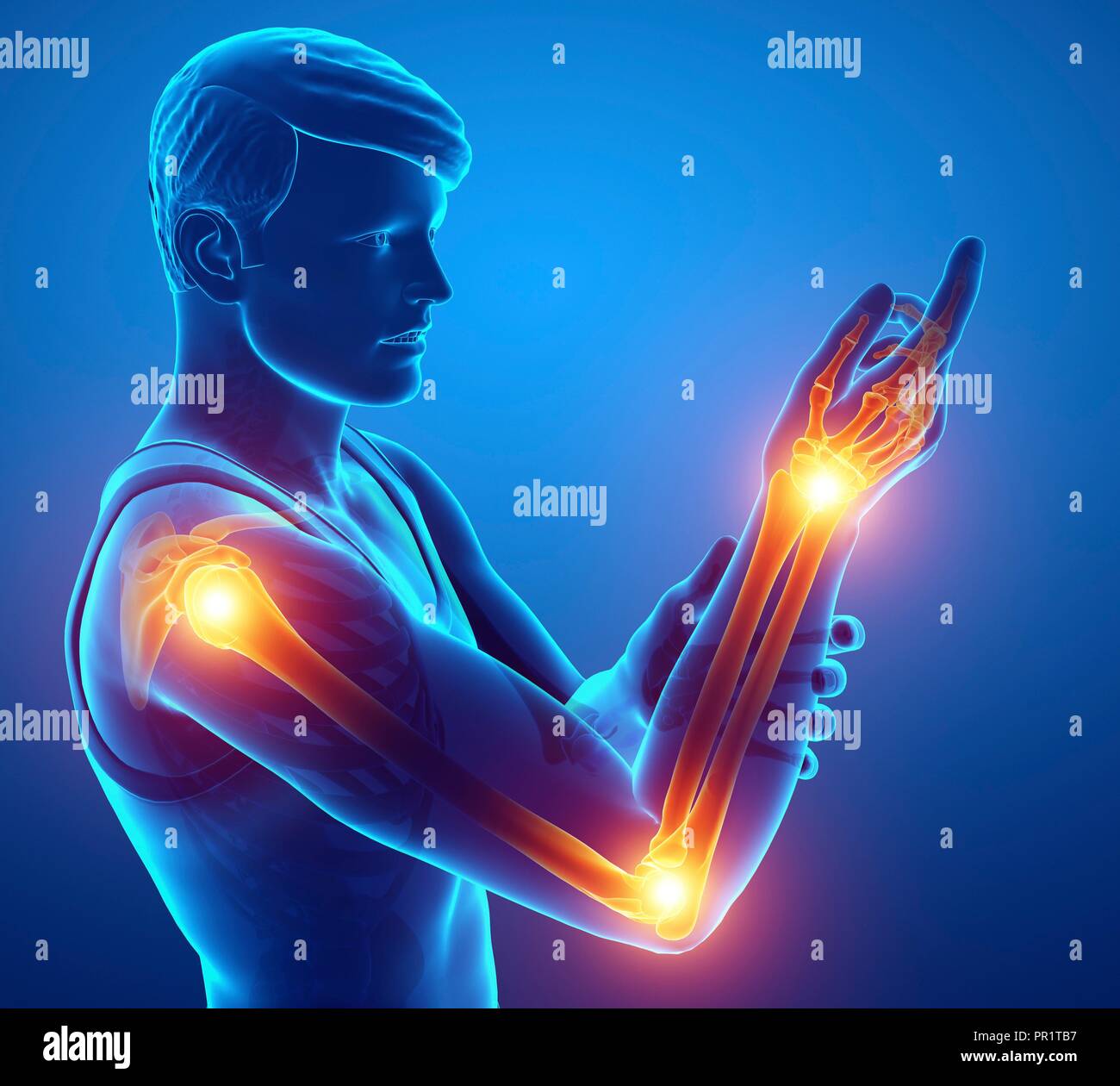 Man with arm pain, computer illustration Stock Photo - Alamy