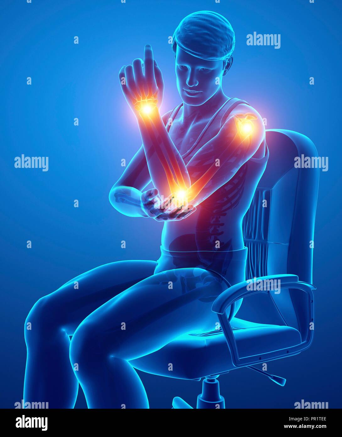 Man with arm pain, computer illustration Stock Photo - Alamy