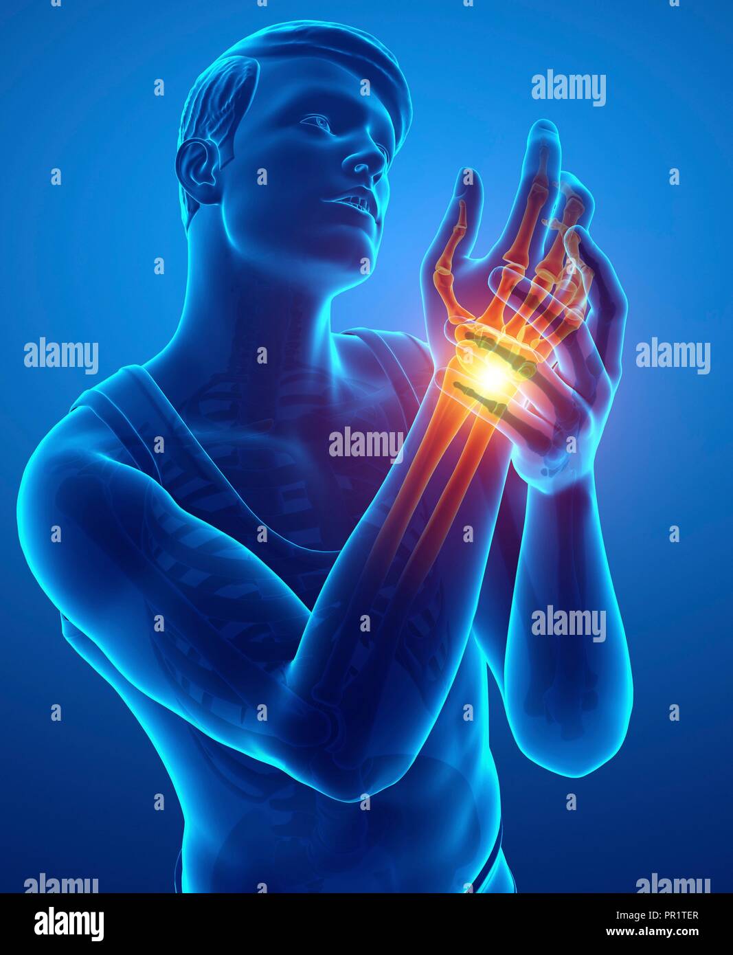 Man with wrist pain, computer illustration Stock Photo - Alamy