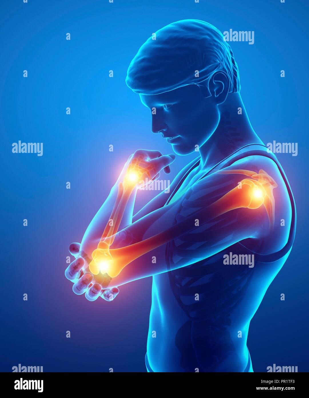 Man with arm pain, computer illustration Stock Photo - Alamy