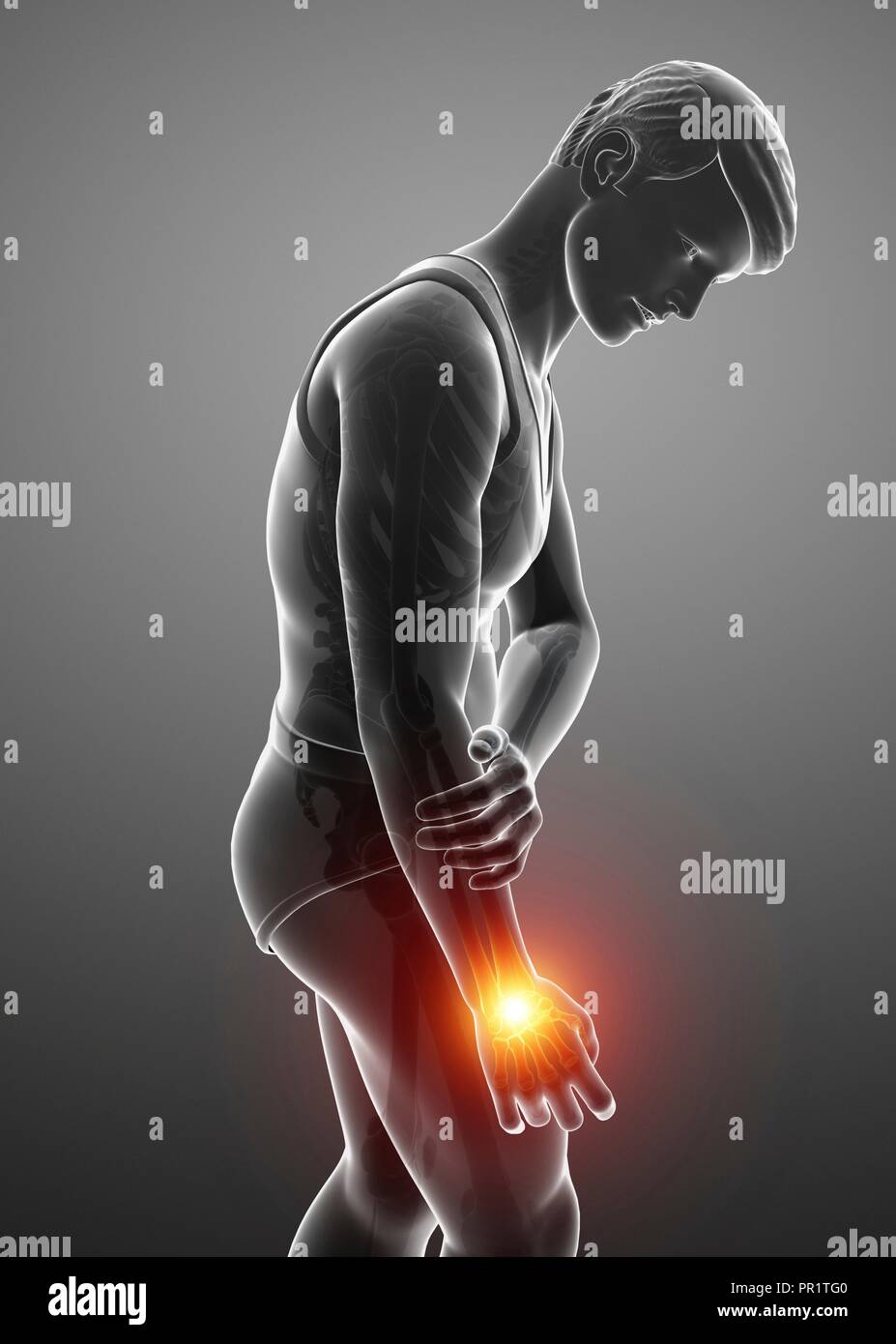 Man with wrist pain, computer illustration Stock Photo - Alamy