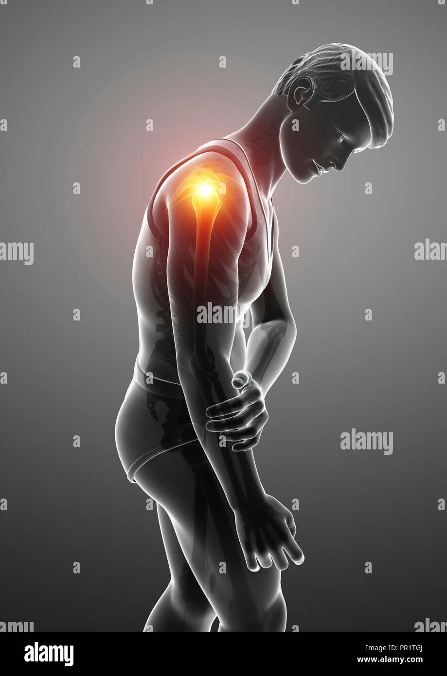 Man with shoulder pain, computer illustration Stock Photo - Alamy