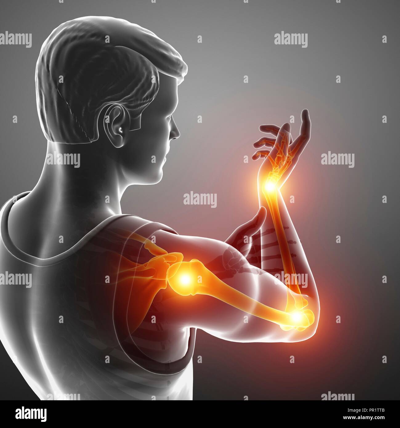 Man with arm pain, computer illustration Stock Photo - Alamy