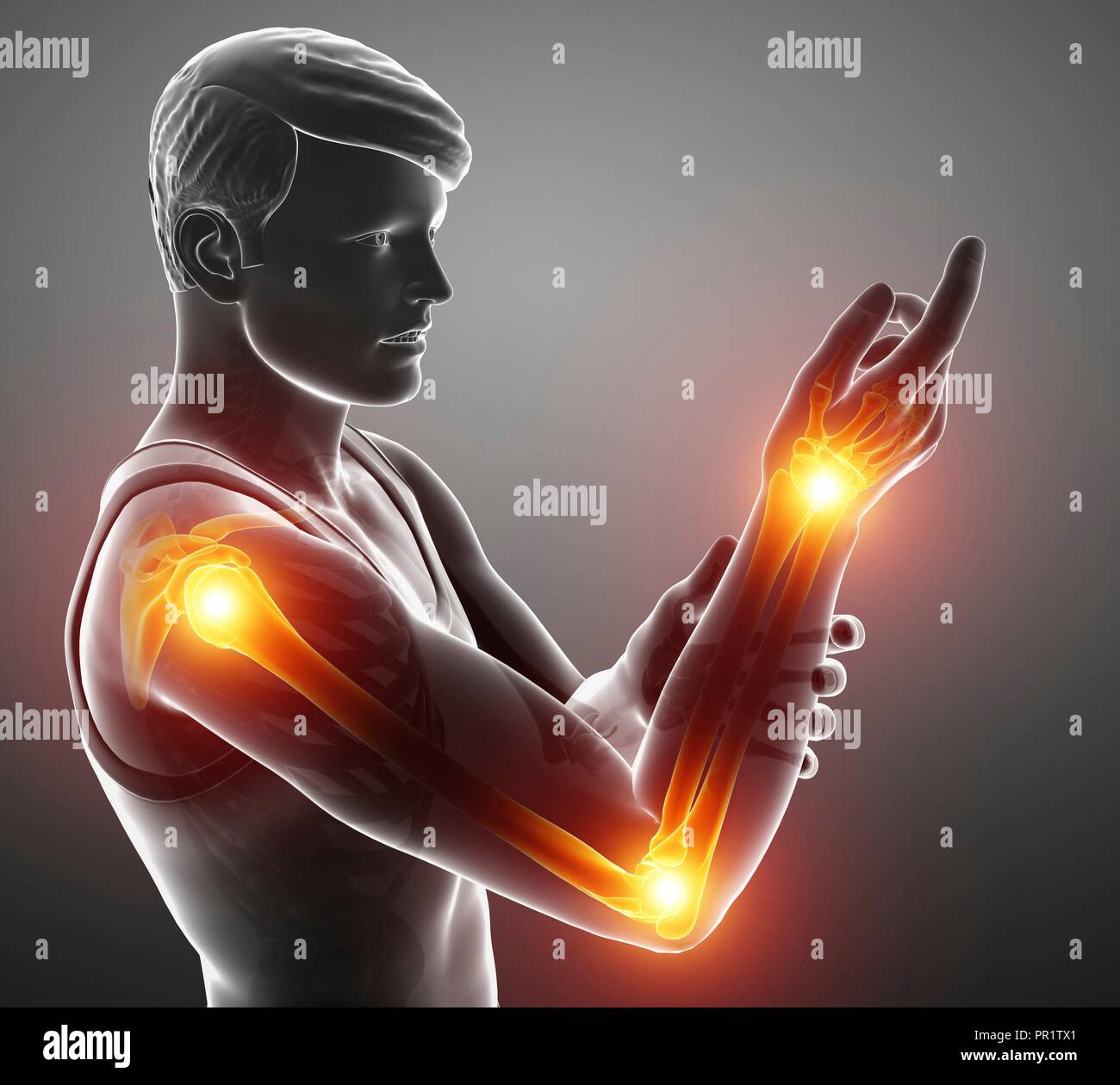 Man with arm pain, computer illustration Stock Photo - Alamy